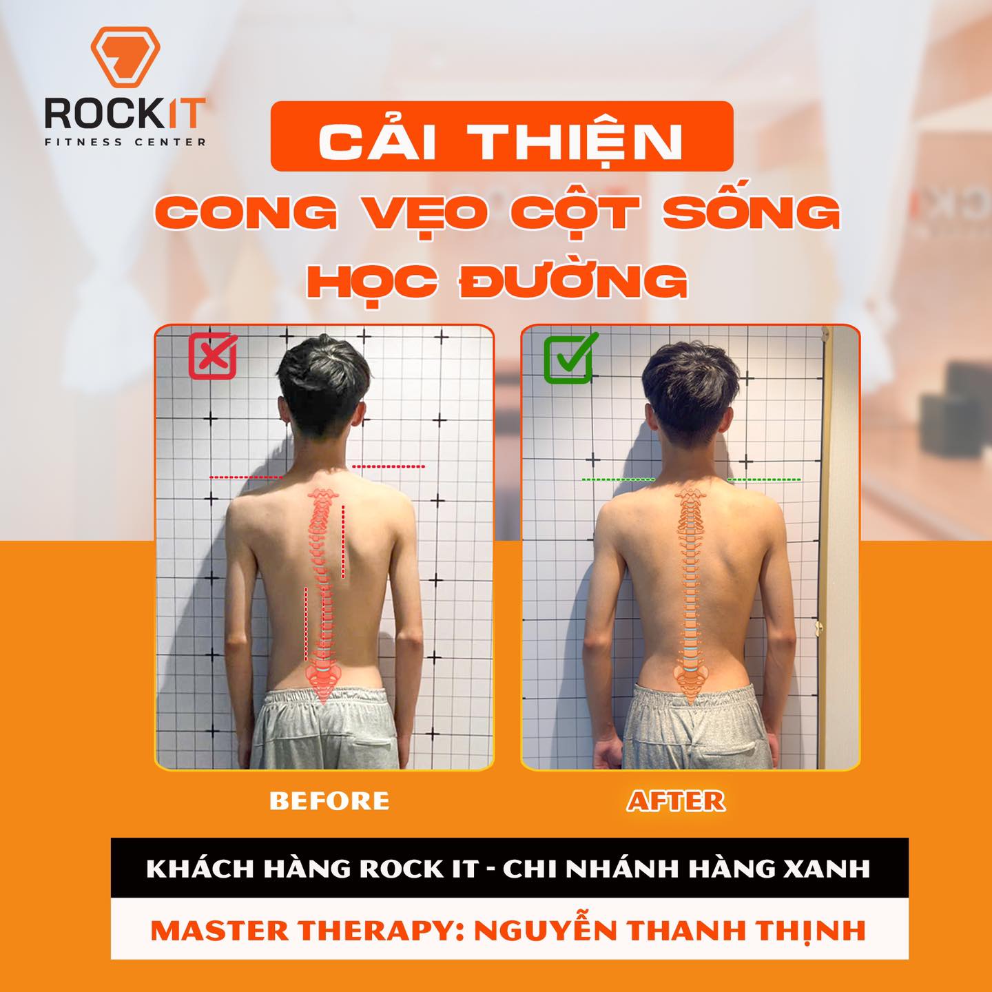 Cong Vẹo Cột Sống Học Đường – Đừng Chủ Quan!